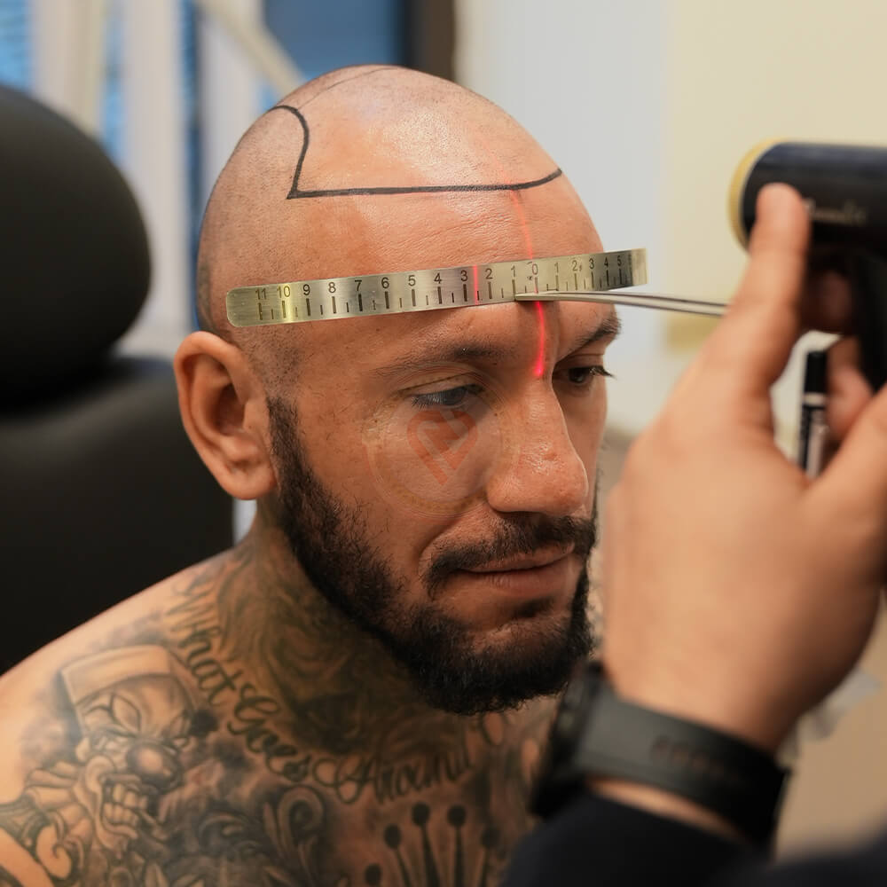 Hair Transplant at Sihairtransplant in Turkey - Si Hair Transplant